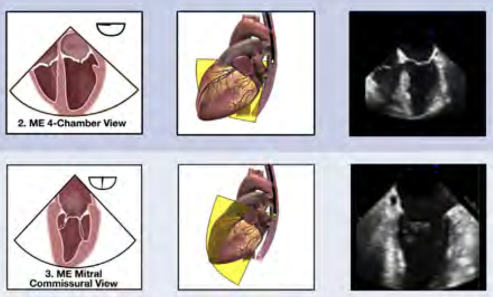 経食道心エコー,TEE